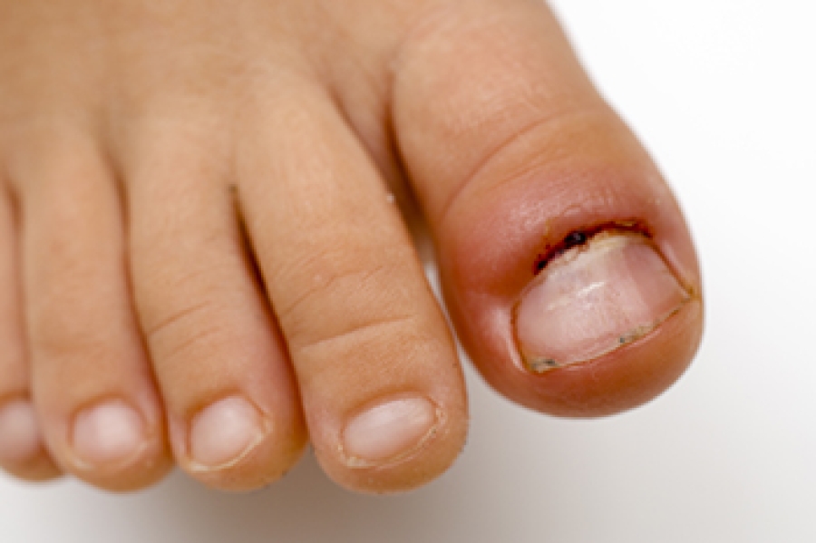 Cellulitis Infection of the Toenail